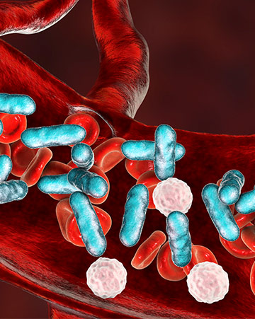 Developing a new treatment for patients with sepsis - RCSI University ...
