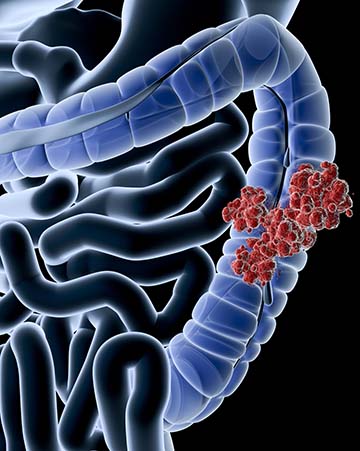 Copper-tweaked drug could provide new options for treating bowel cancer ...